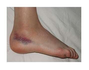 Guide to Common Foot Injuries - Footgood